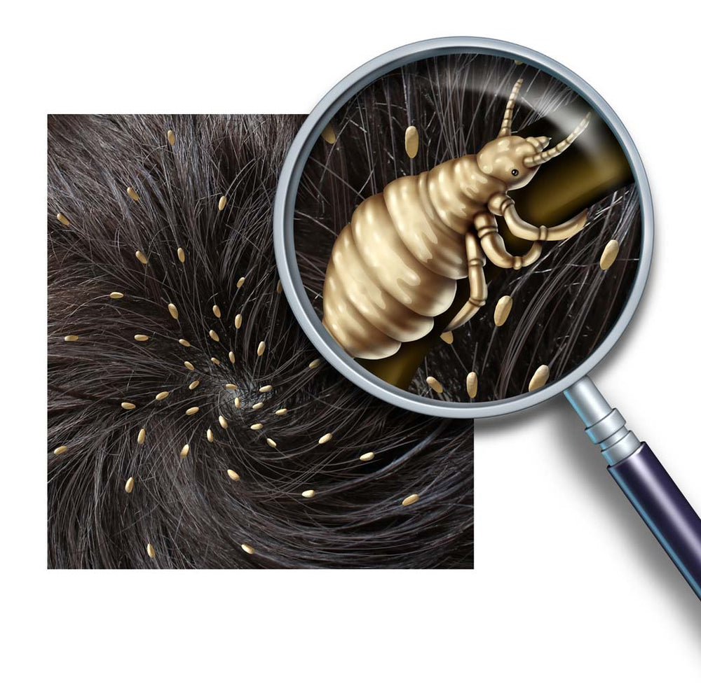 How to Get Rid of Lice Naturally