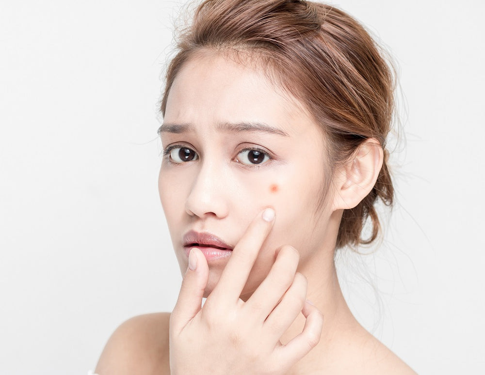 6 Reasons for Acne (Infographic)