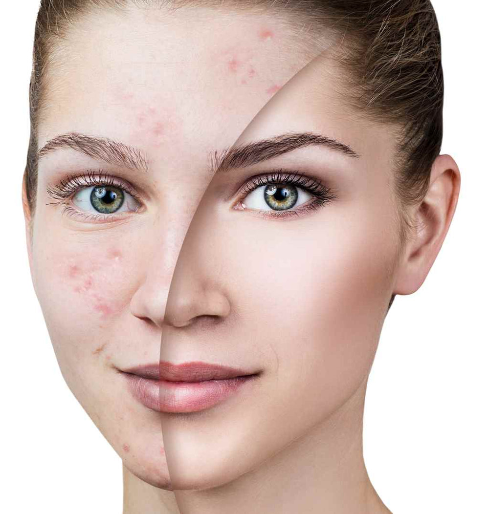 How to Use Clove Oil to Get Rid of Face Acne Scars