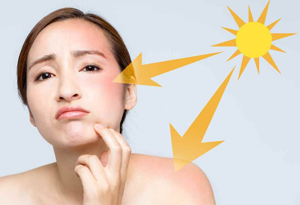 Tips To Cure Sunburn Infographic